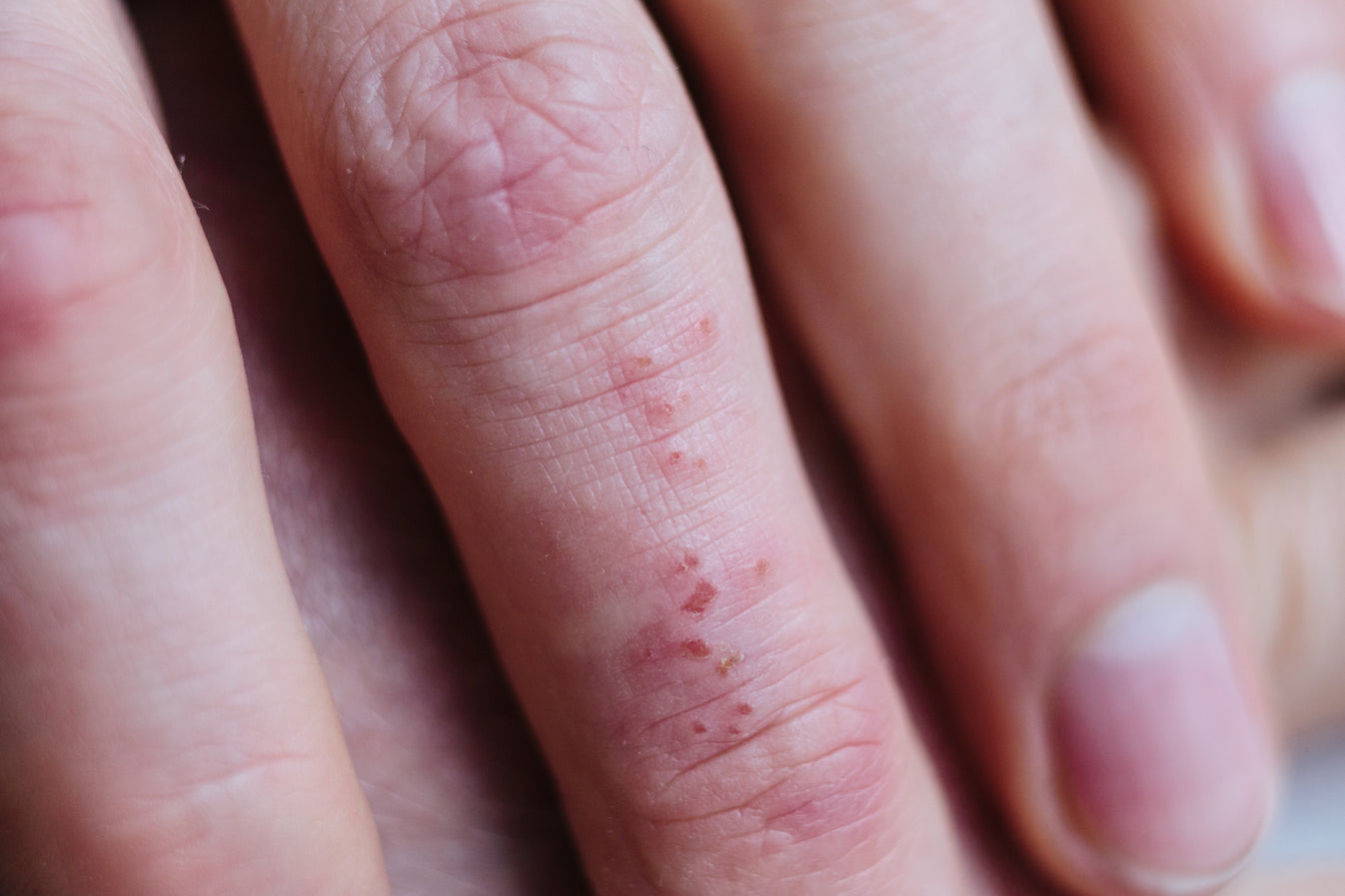 Scabies Treatment Bath Soak | 15 mL – Naturasil