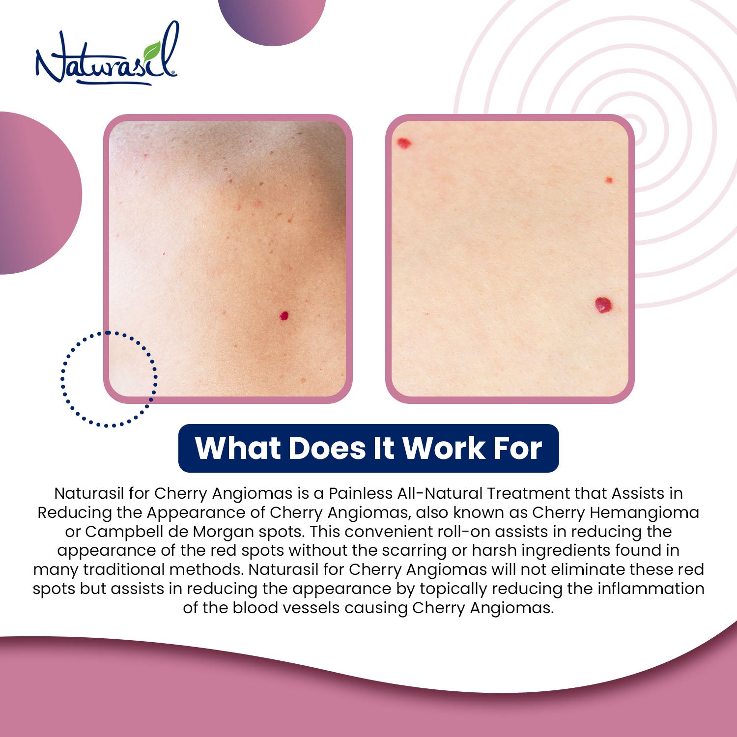 Cherry Angiomas Treatment by Naturasil