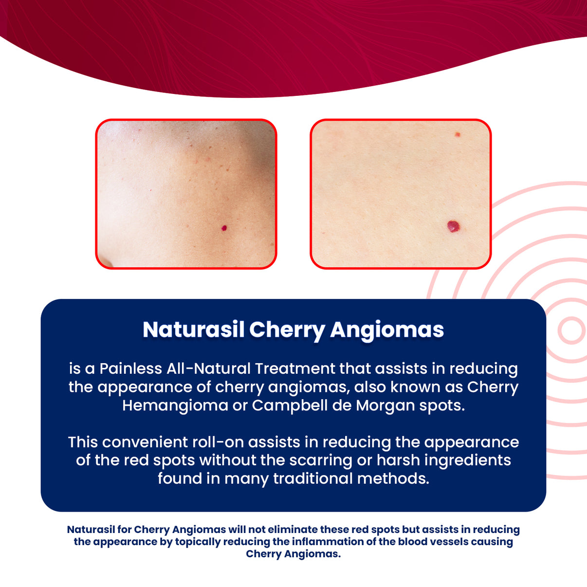 Cherry Angiomas Treatment by Naturasil