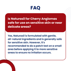 Cherry Angiomas Treatment by Naturasil